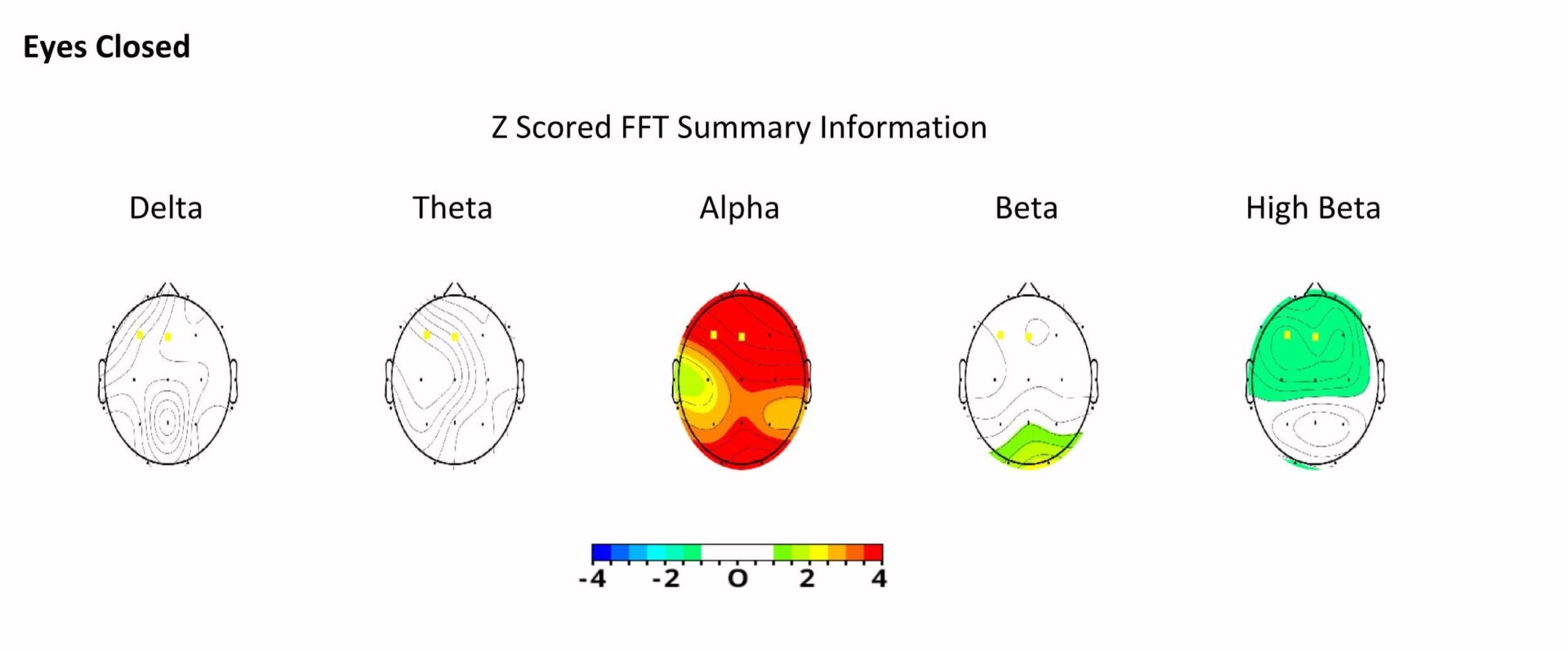 Remote Neurofeedback: Hack Your Brain From Anywhere In The World